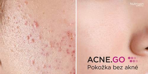 Tablety na akné AcneGo 60tbl. | biome