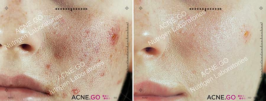 Tablety na akné AcneGo 60tbl. | biome